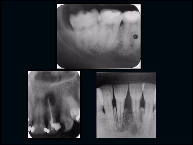 Diagnostico Radiografico de Caries | PDF