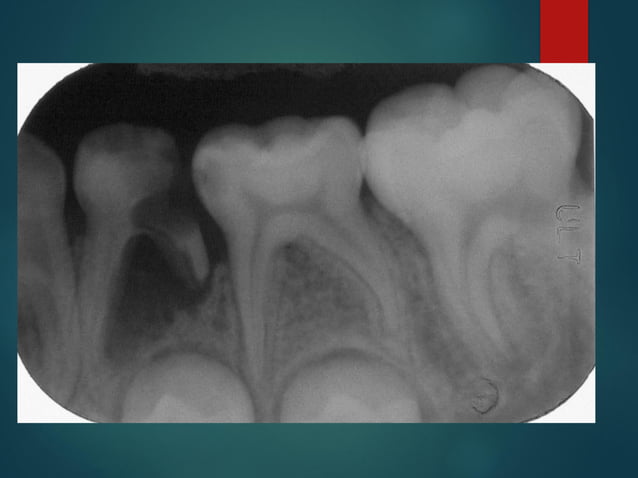 Diagnostico Radiografico de Caries | PDF