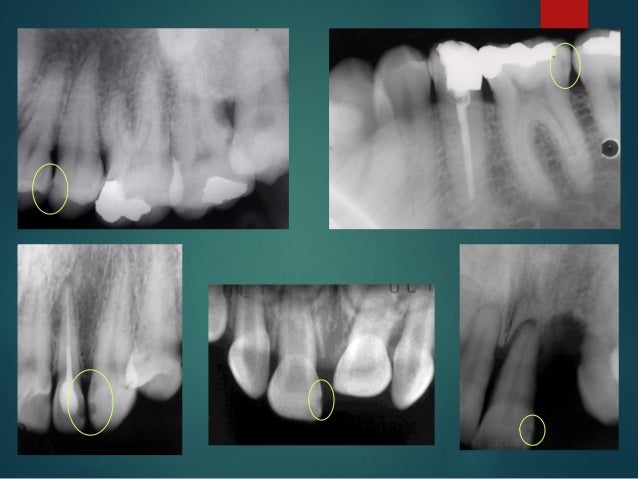 Osteitis Condensante