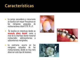 Caries recidivante | PPTX