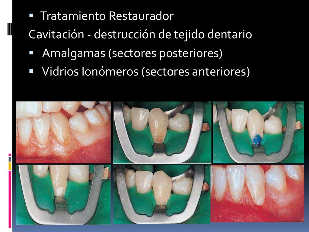 Caries residual
