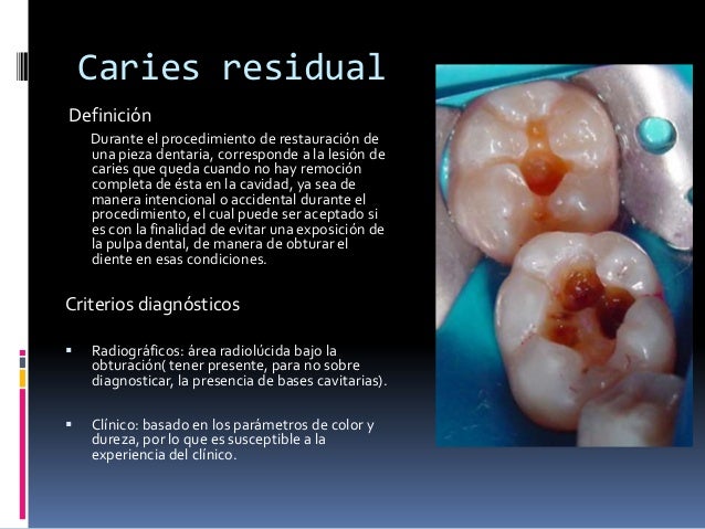 Caries residual