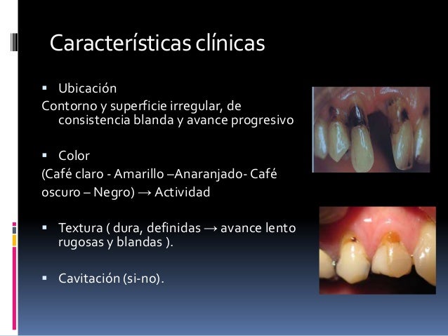 Caries residual