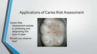 Caries risk assesment | PPTX