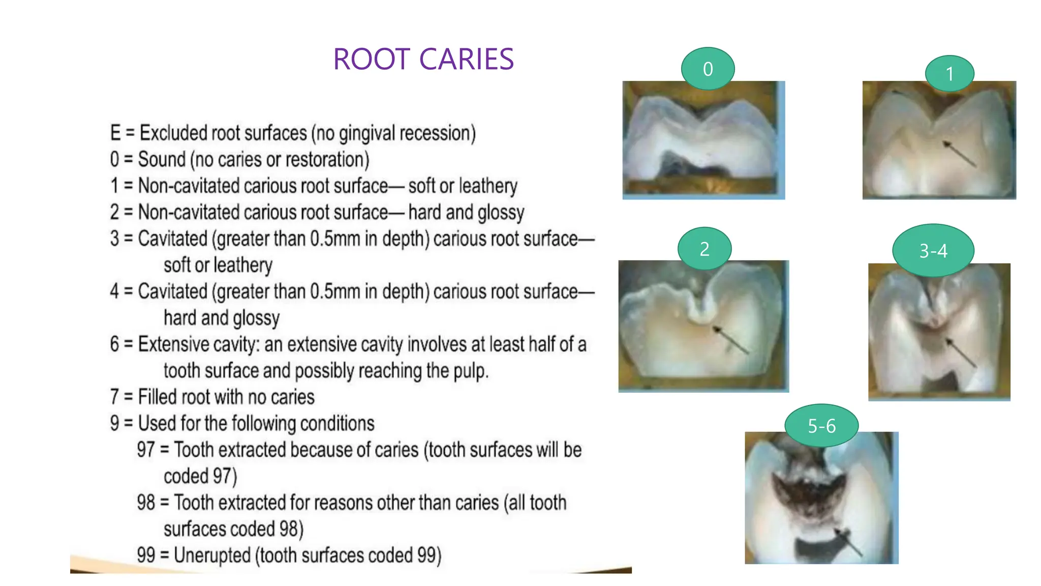 Caries risk assessment in detail description | PPTX