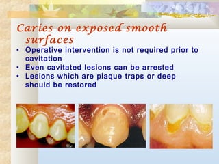 Caries Treatment | PPT