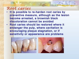 Caries Treatment | PPT