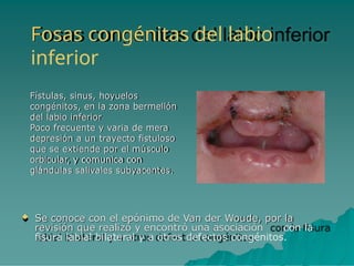 CARIES Y OTRAS ENFERMEDADES SEGUN CODIGO CIE 10.pptx