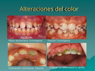 CARIES Y OTRAS ENFERMEDADES SEGUN CODIGO CIE 10.pptx