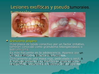 CARIES Y OTRAS ENFERMEDADES SEGUN CODIGO CIE 10.pptx