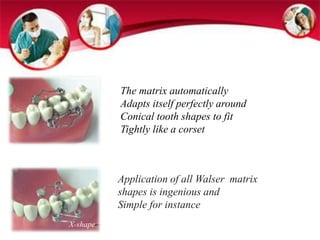 Composi-Tight 3D™ Sectional Matrix | PPTX