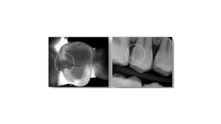 Dexis CariVu Caries Detection Demo | PDF