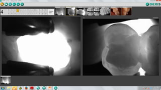 Dexis CariVu Caries Detection Demo | PDF