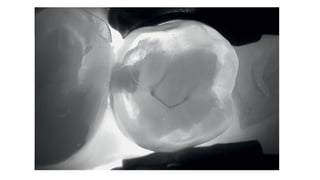 Dexis CariVu Caries Detection Demo | PDF