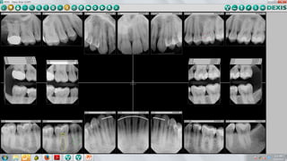 Dexis CariVu Caries Detection Demo | PDF