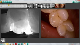 Dexis CariVu Caries Detection Demo | PDF