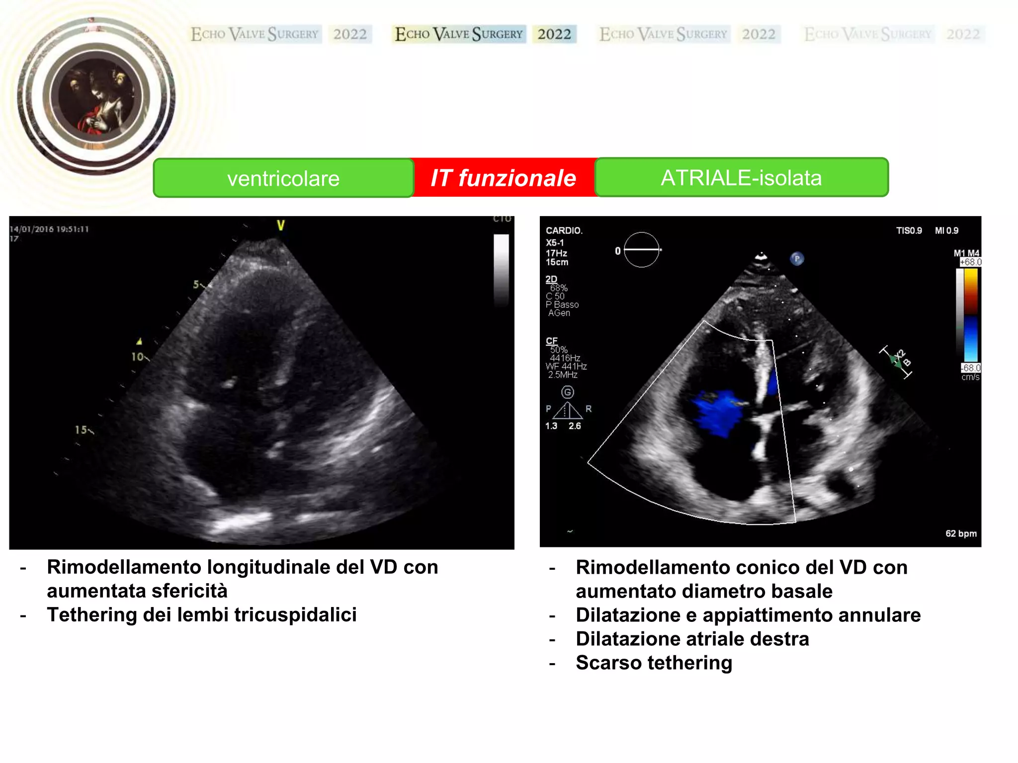 Insufficienza tricuspidalica isolata | PPTX