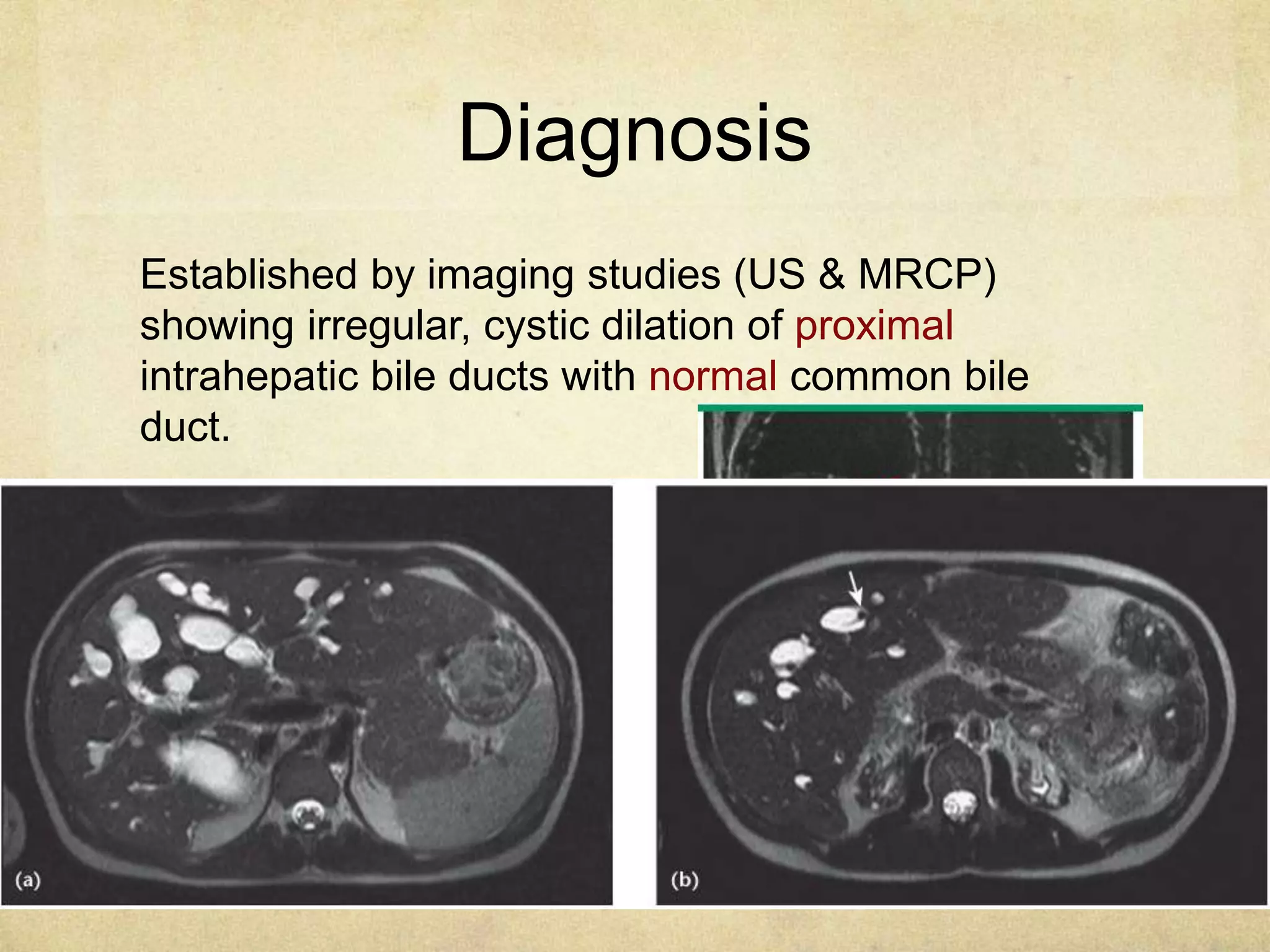 Caroli syndrome | PPTX