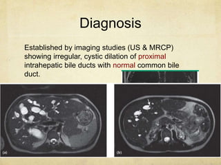 Caroli syndrome | PPTX