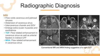 Caroticocavernous fistula HAKU | PPTX