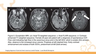 Caroticocavernous fistula HAKU | PPTX