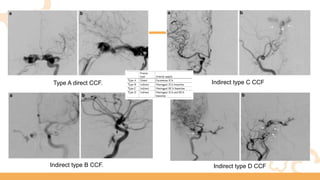 Caroticocavernous fistula HAKU | PPTX