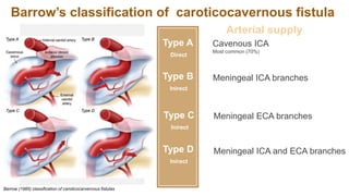 Caroticocavernous fistula HAKU | PPTX