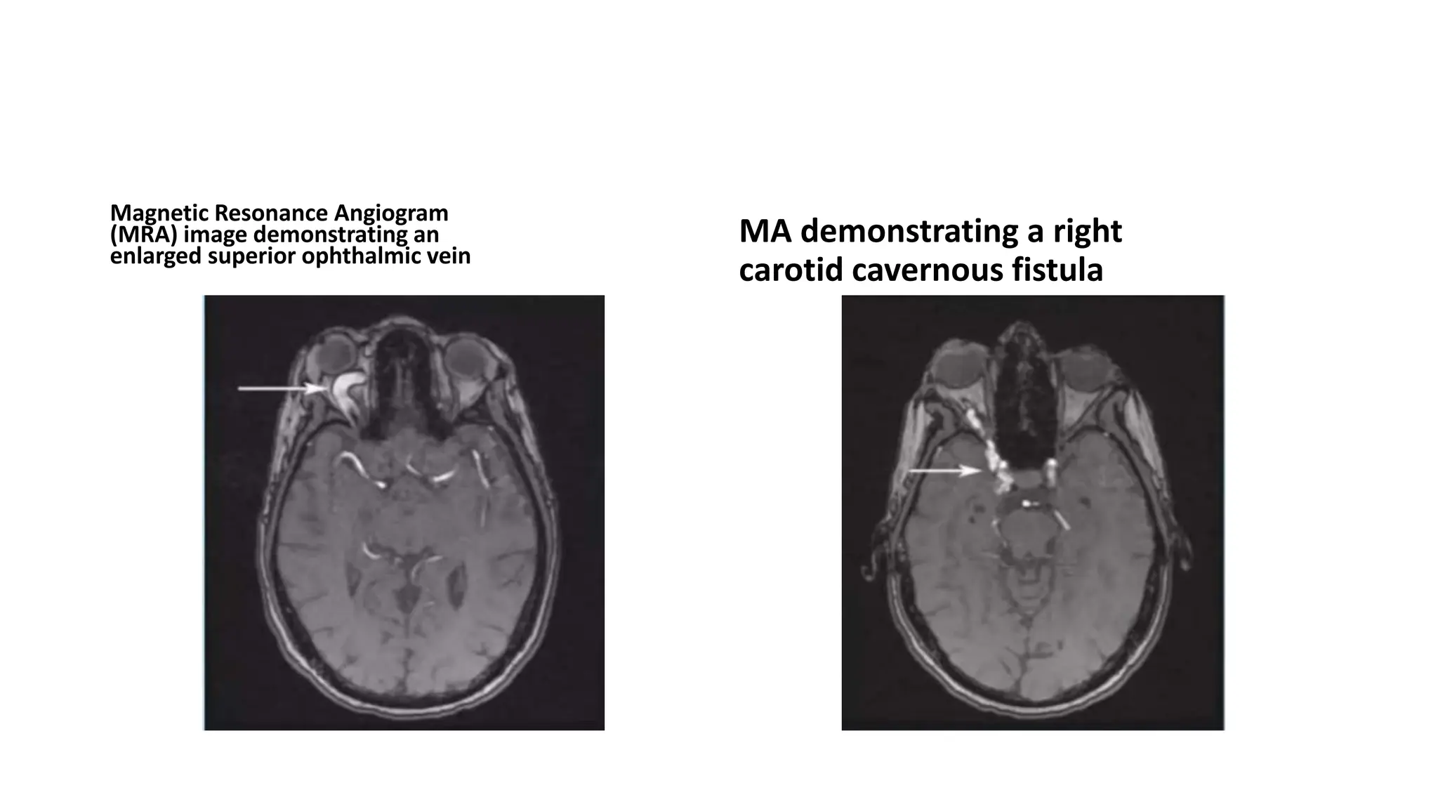 Carotico-cavernous fistula Presentation. | PPTX