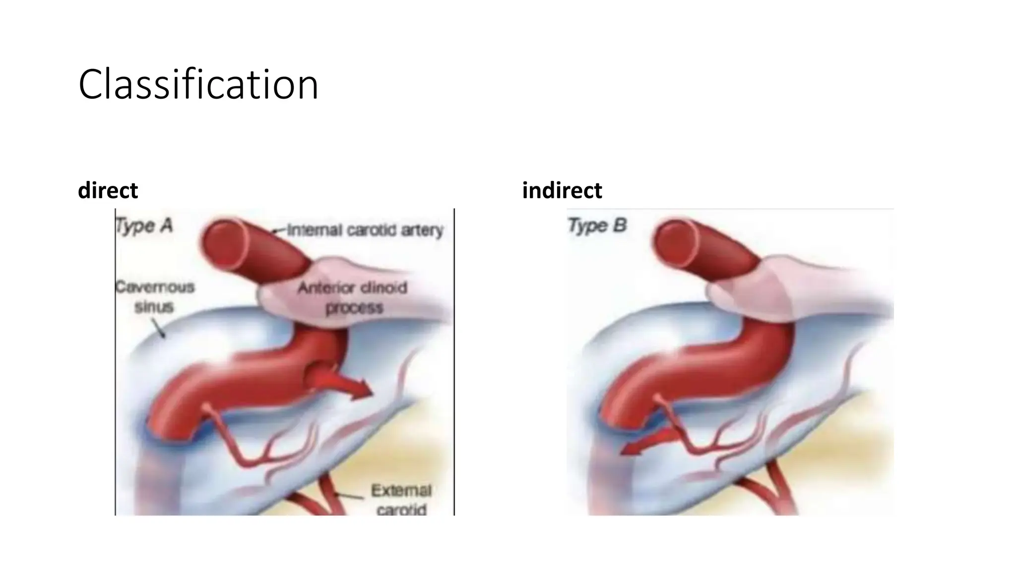 Carotico-cavernous fistula Presentation. | PPTX