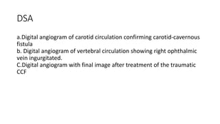 Carotico-cavernous fistula Presentation. | PPTX