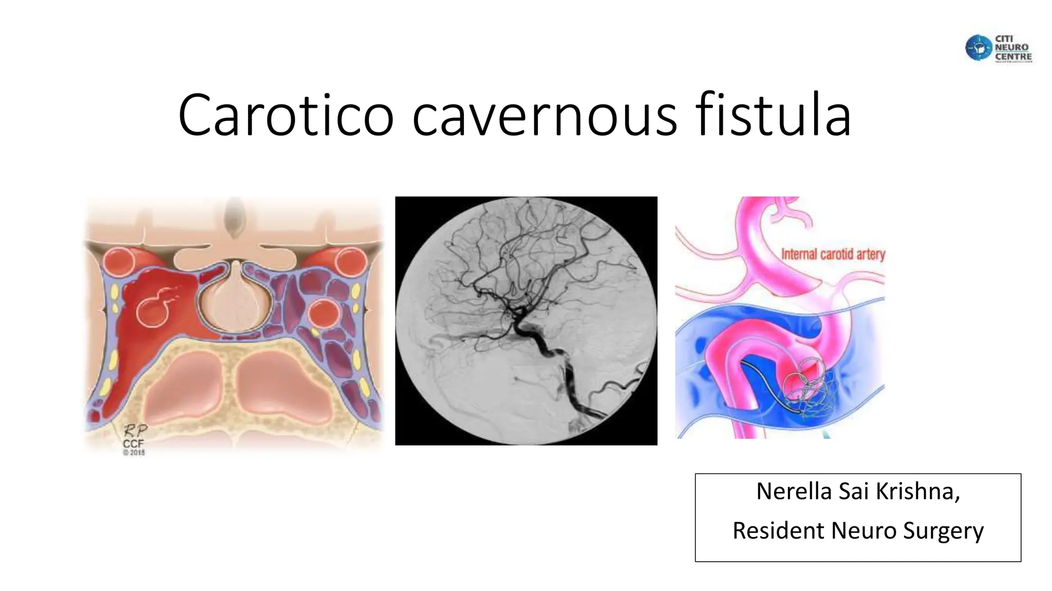 Carotico cavernous fistula and its managment | PPT