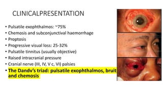Carotico cavernous fistula and its managment | PPT