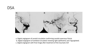 Carotico cavernous fistula and its managment | PPT