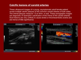 Carotid | PDF
