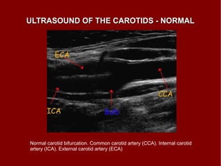 Carotid | PDF