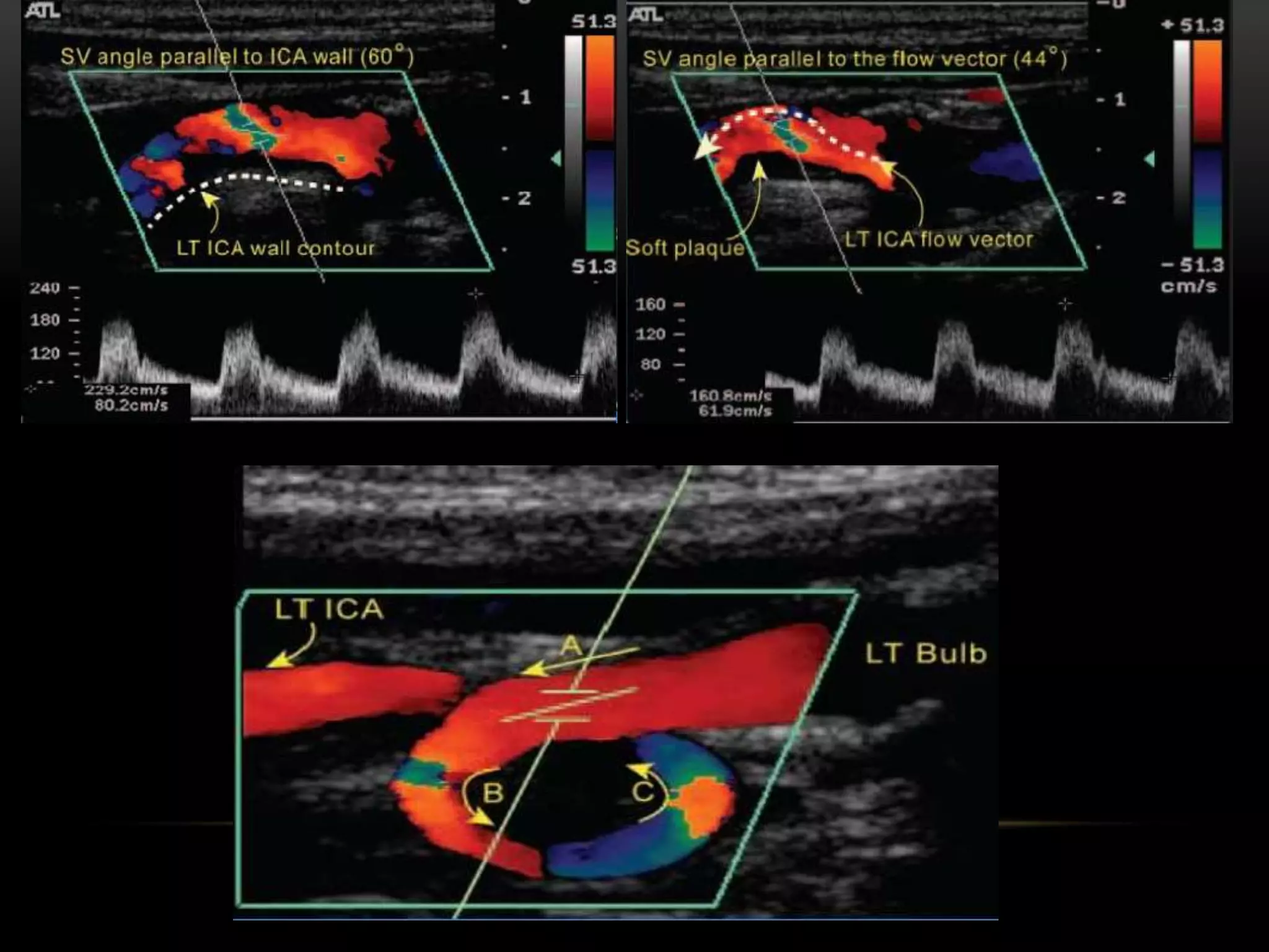 CAROTID DOPPLER STUDY | PPTX