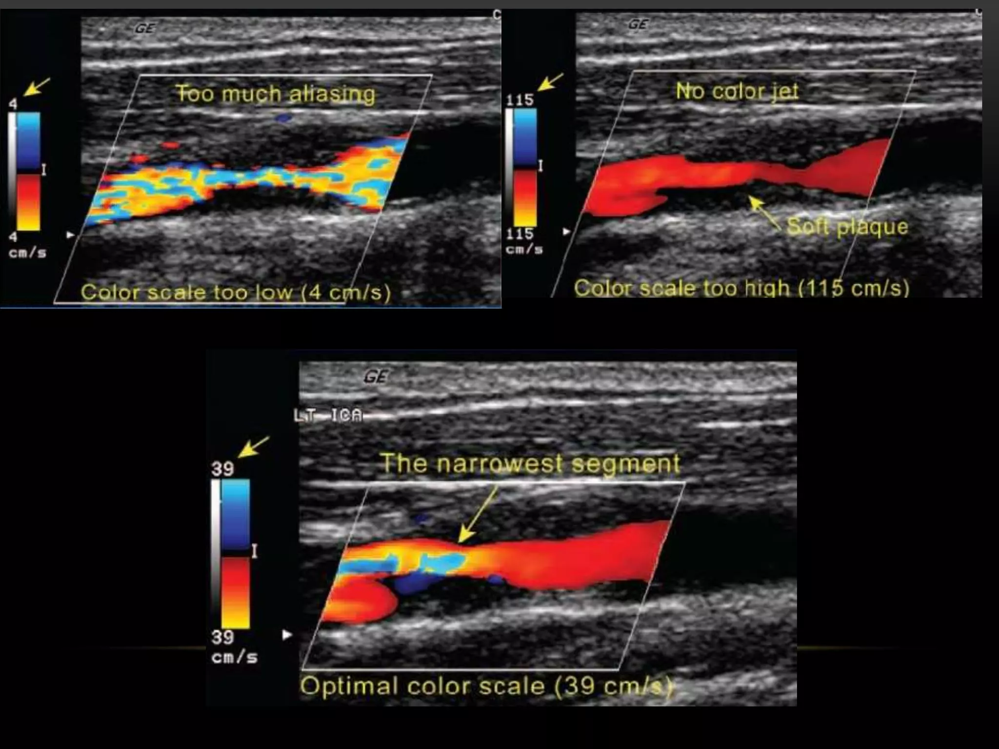 CAROTID DOPPLER STUDY | PPTX
