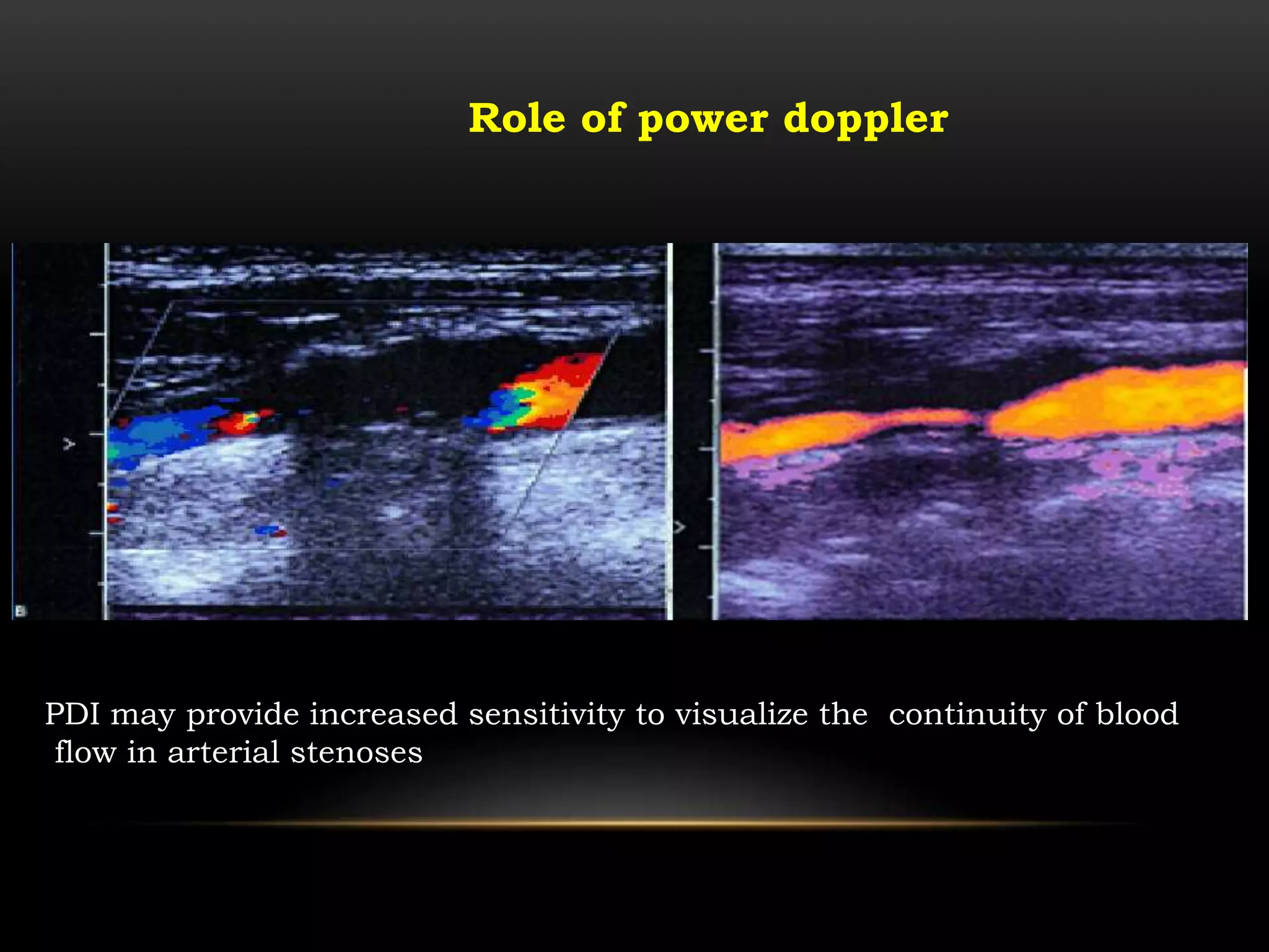 CAROTID DOPPLER STUDY | PPTX