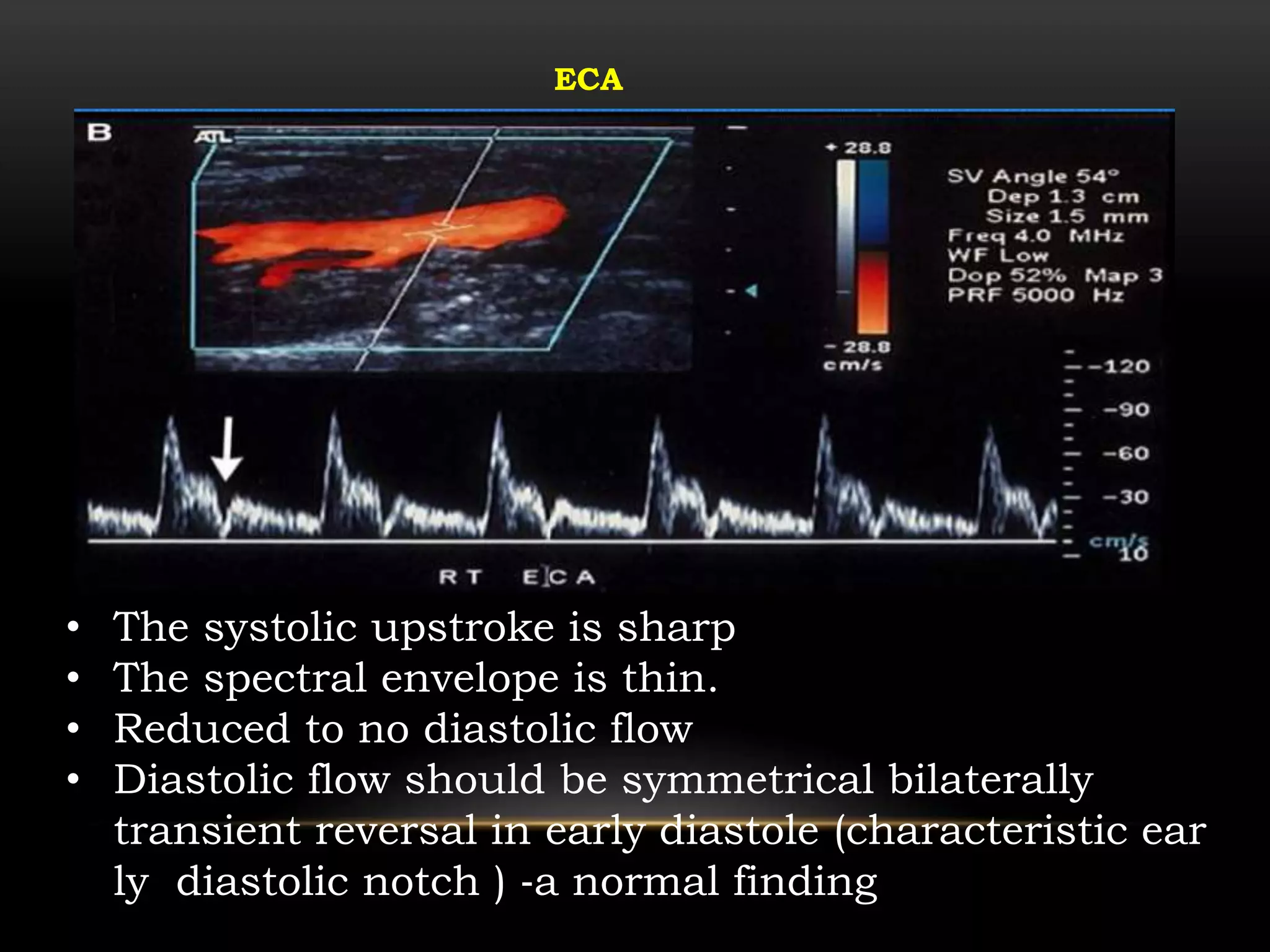 CAROTID DOPPLER STUDY | PPTX