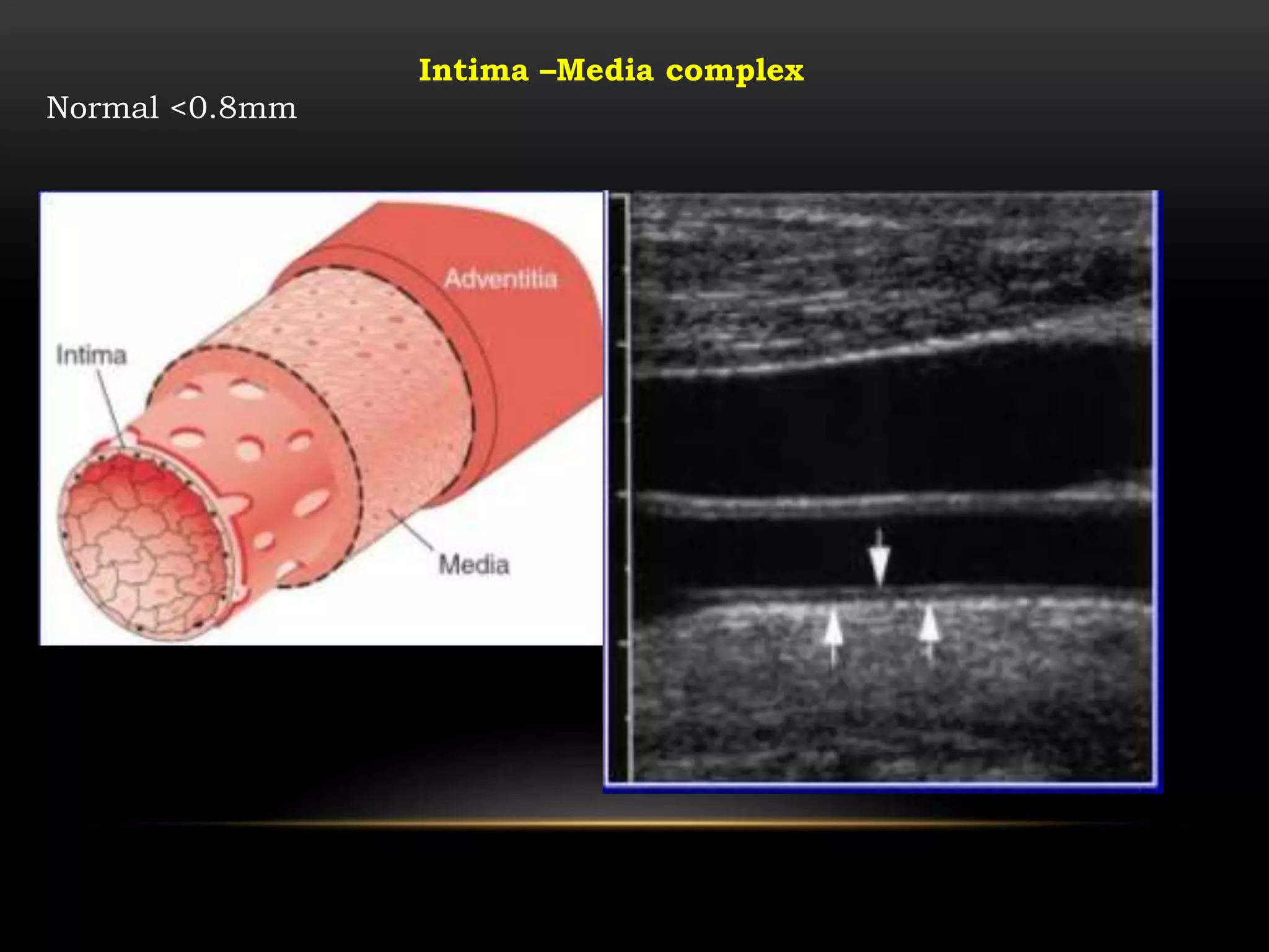 CAROTID DOPPLER STUDY | PPTX