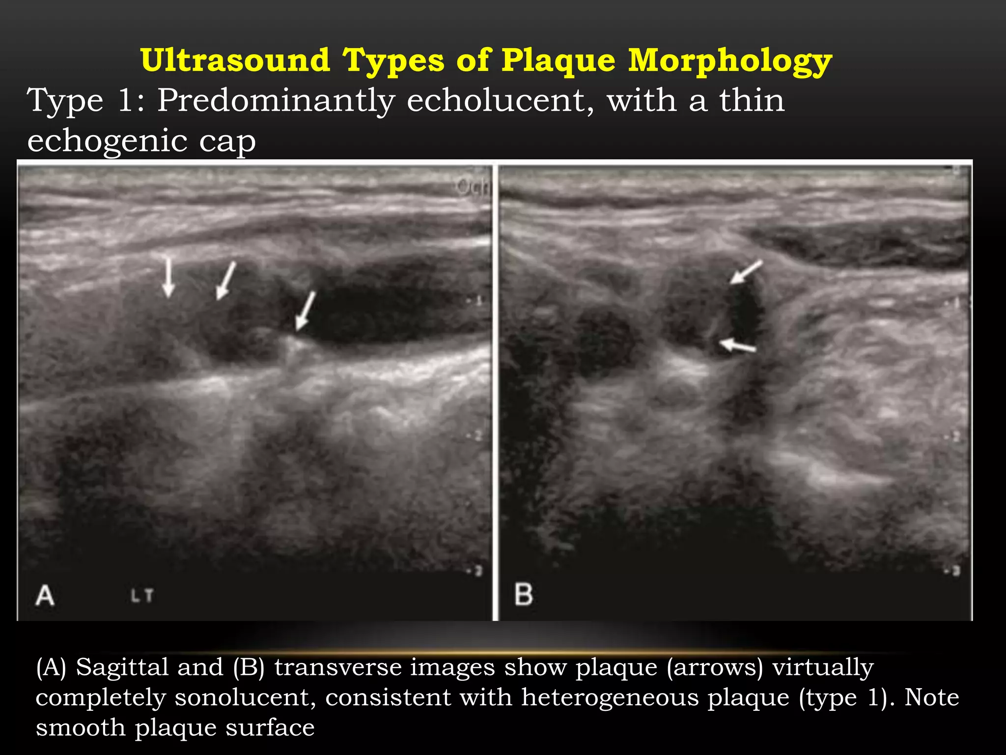 CAROTID DOPPLER STUDY | PPTX