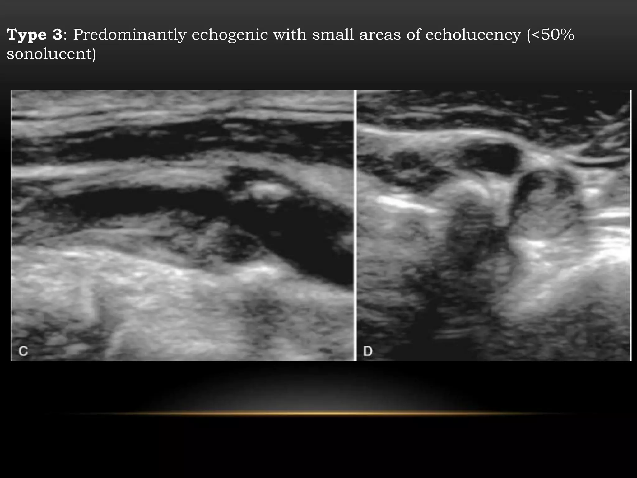 CAROTID DOPPLER STUDY | PPTX