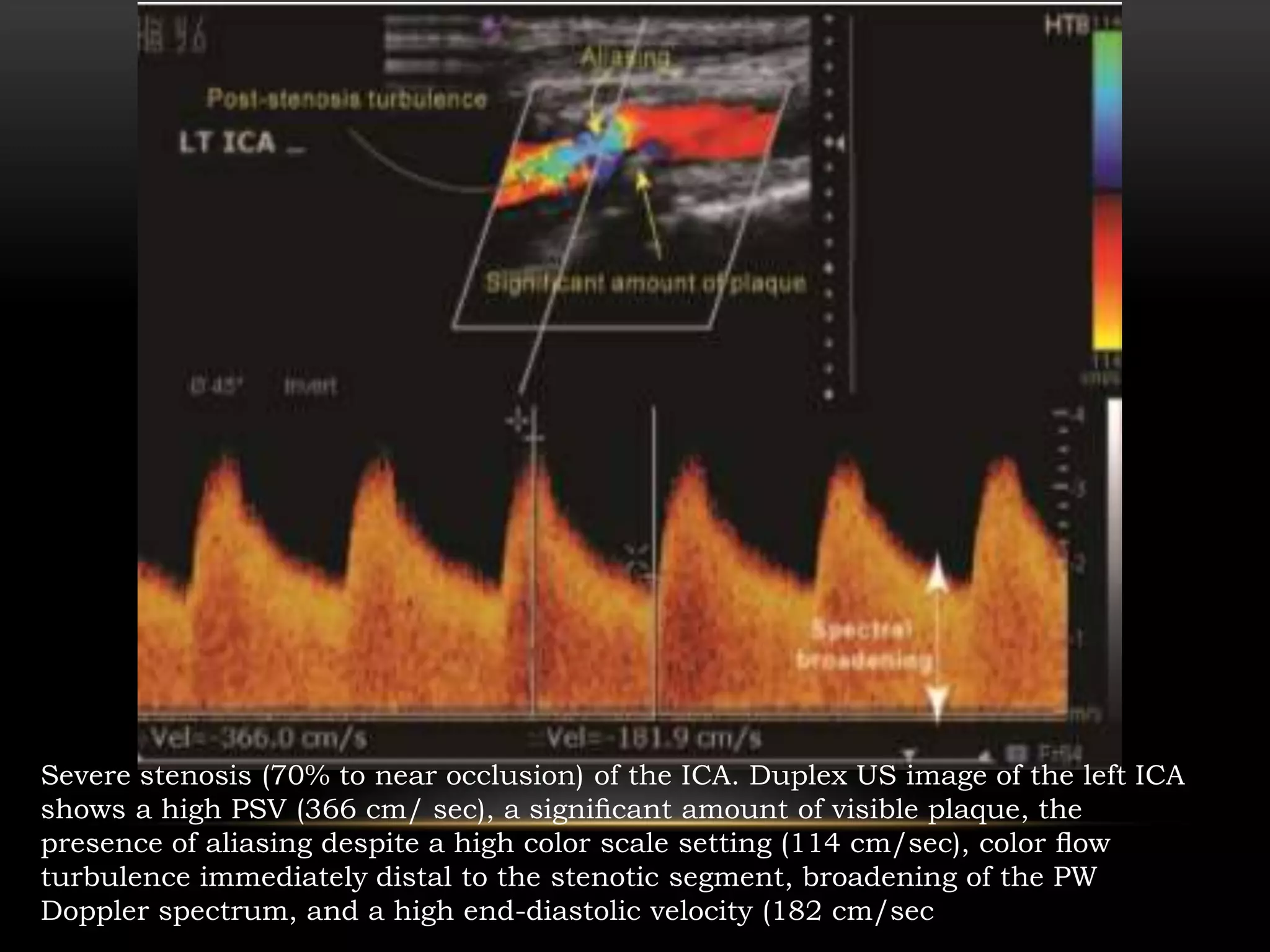 CAROTID DOPPLER STUDY | PPTX