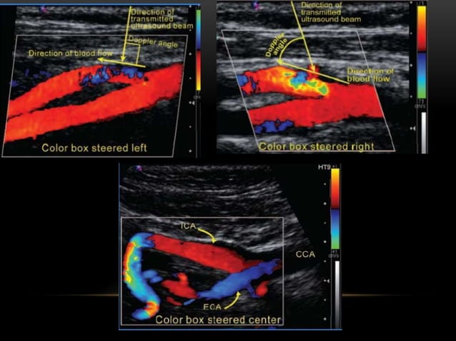 CAROTID DOPPLER STUDY | PPTX