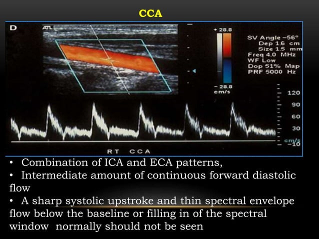 CAROTID DOPPLER STUDY | PPTX