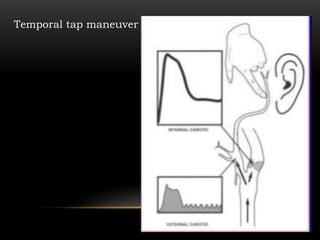 CAROTID DOPPLER STUDY | PPTX