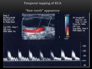 CAROTID DOPPLER STUDY | PPTX