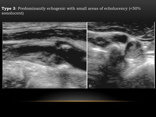 CAROTID DOPPLER STUDY | PPTX