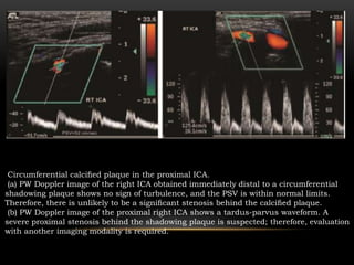 CAROTID DOPPLER STUDY | PPTX