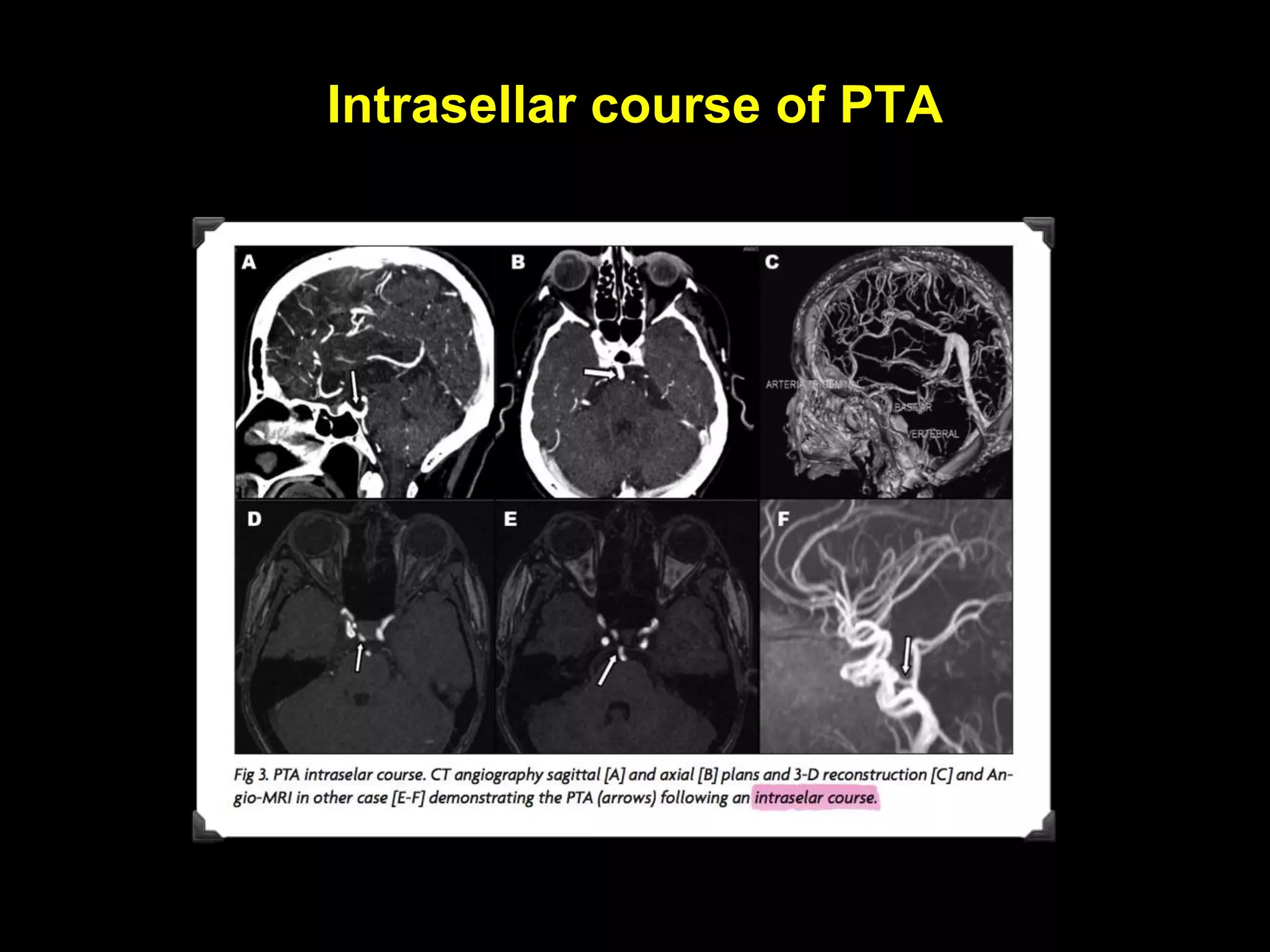Carotid vertebral anastomosis | PPTX